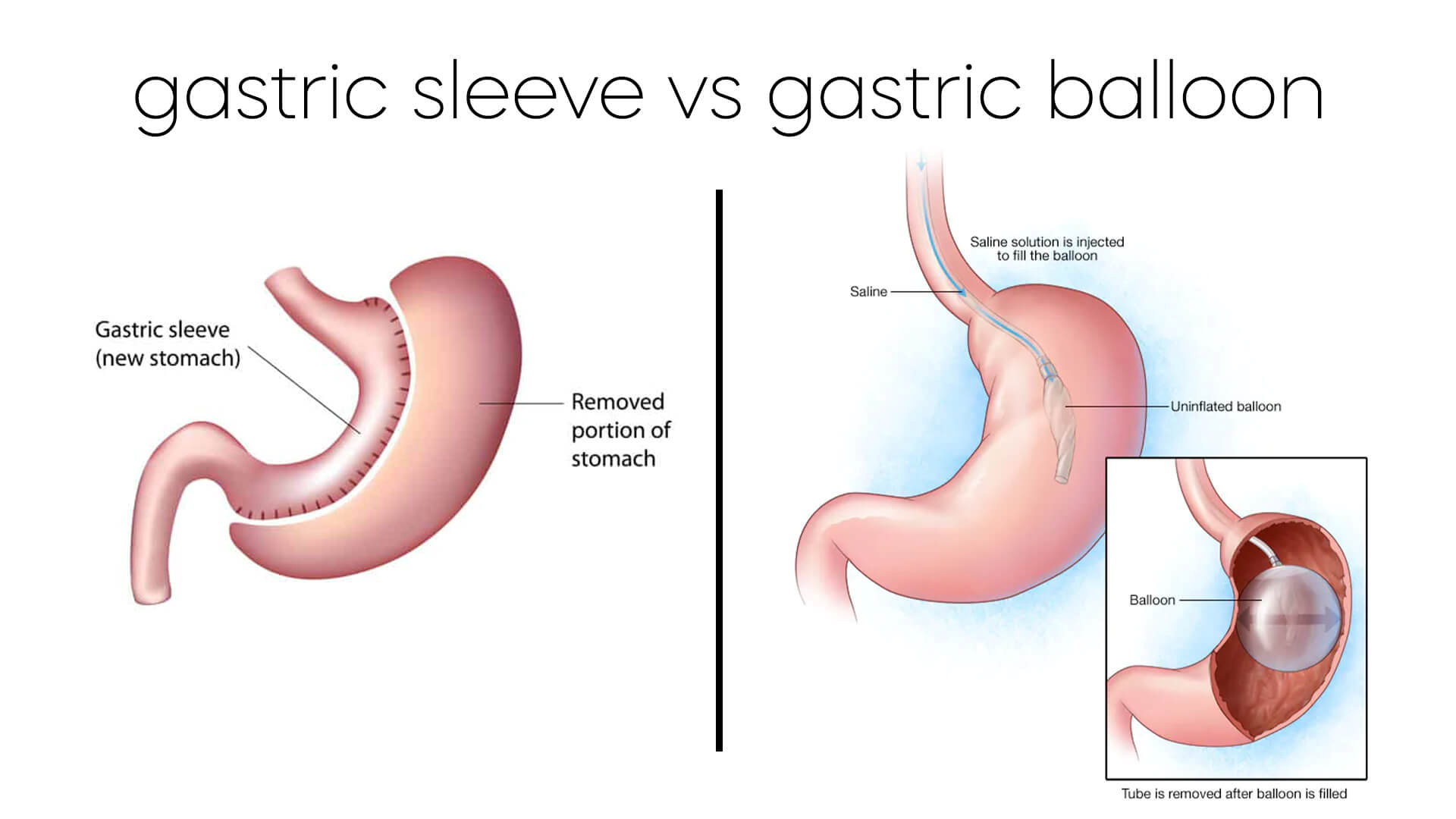 Gastric Sleeve vs. Gastric Balloon: Understanding the Differences and Deciding What's Right for ...