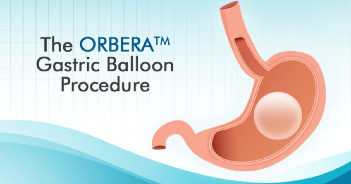 Gastric Balloon Surgery - Dr. Hector Perez, MD